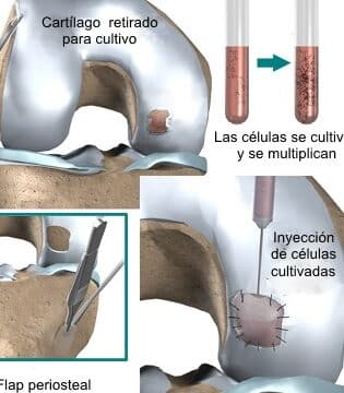 Tratamiento de lesiones condrales: una guía completa - Profesionales de ...